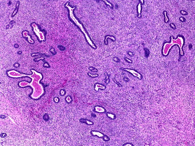 phyllode tumor benign