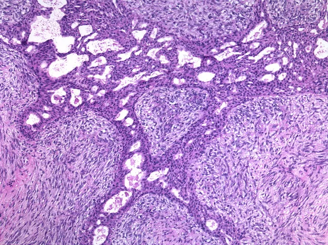 Phyllodes Tumor : Low-grade with Epithelial Hyperplasia