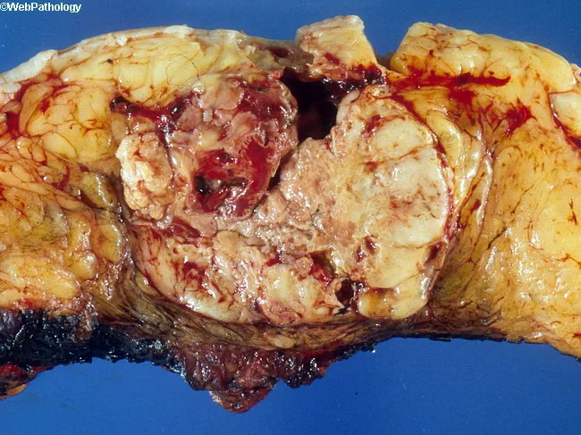 phyllodes tumor nhs