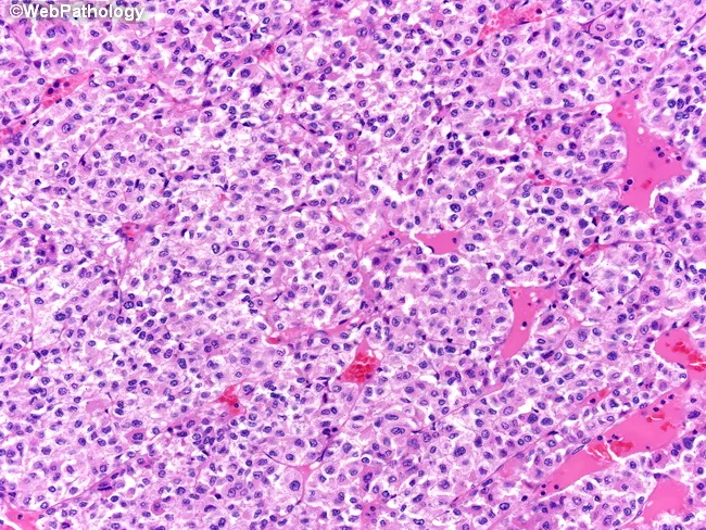 Adrenal Adenoma : Spironolactone Bodies