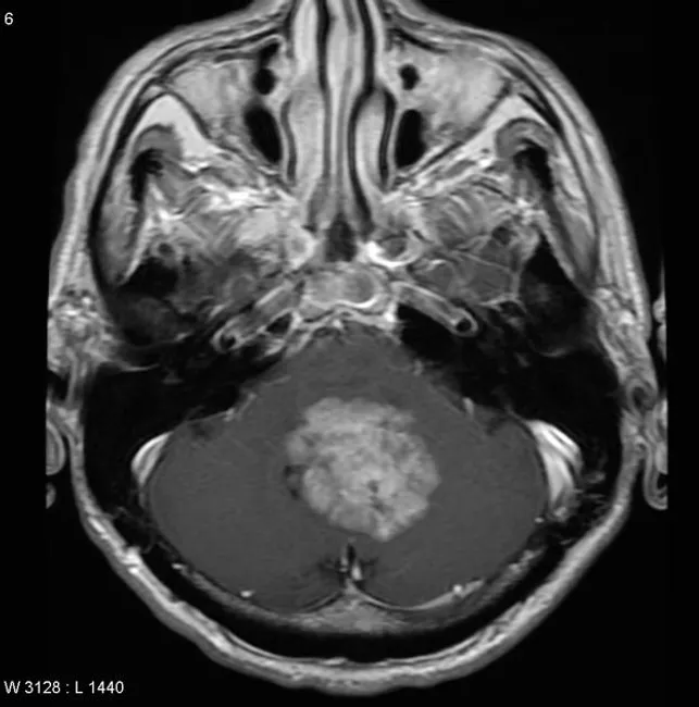 Ependymoma : MRI Scan