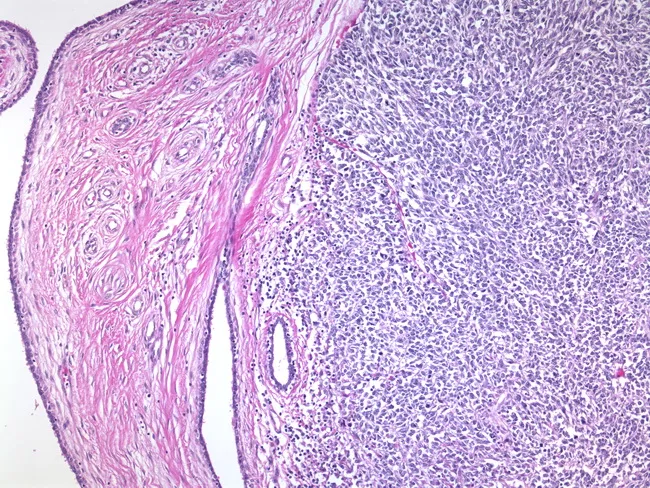 Phyllodes Tumor : High-grade with Rhabdomyosarcoma
