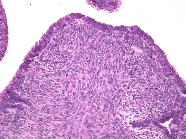 Phyllodes Tumor : High-grade with Sarcoma, NOS