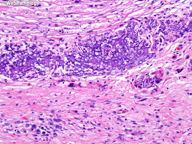 Ganglio-neuroblastoma : Calcification