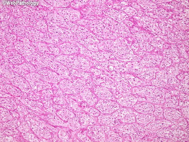 Pheochromocytoma : Zellballen pattern