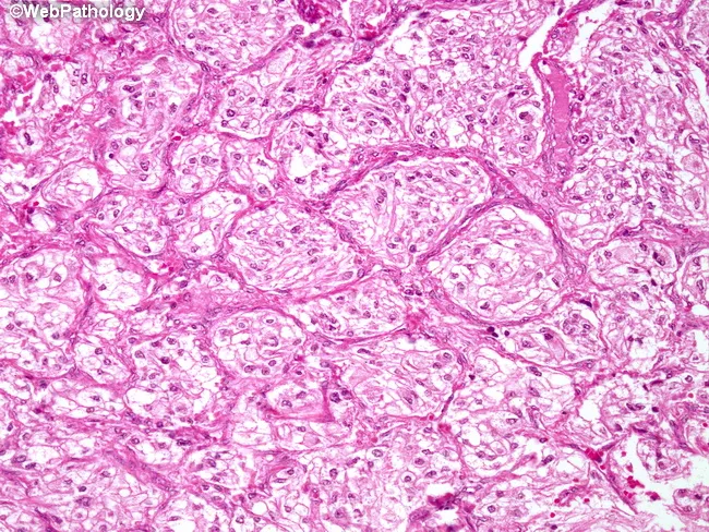 Pheochromocytoma : Zellballen pattern