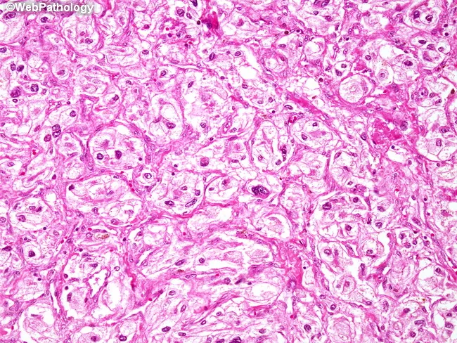 Pheochromocytoma : Zellballen pattern
