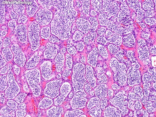 Pheochromocytoma : Zellballen pattern