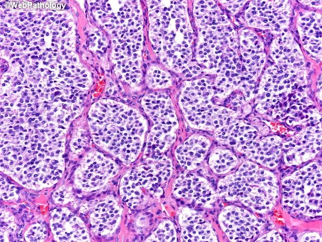 Pheochromocytoma : Zellballen pattern