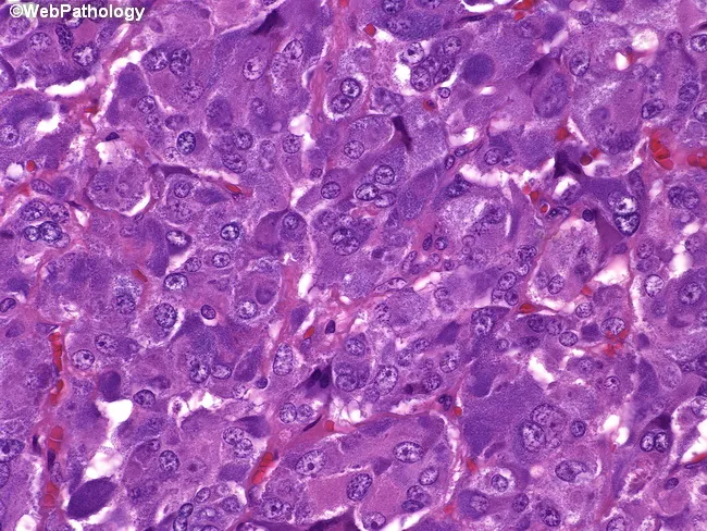 Pheochromocytoma