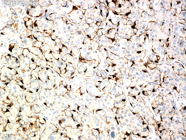 Pheochromocytoma : S100, Sustentacular Cells