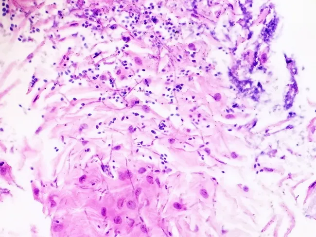 Candida Esophagitis : Diagnosis