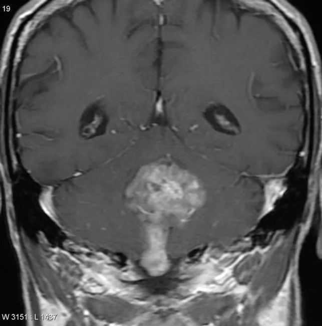 Ependymoma : MRI Scan