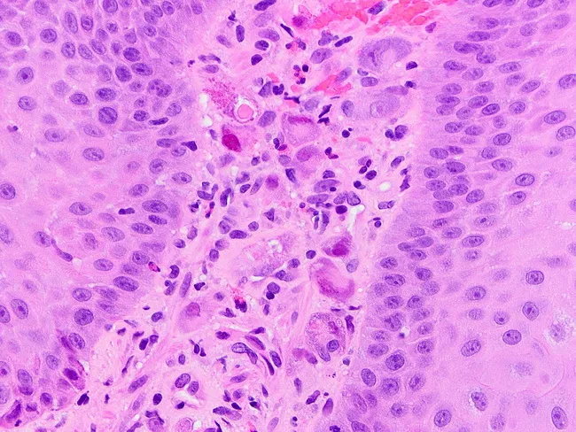 CMV Esophagitis : Microscopic