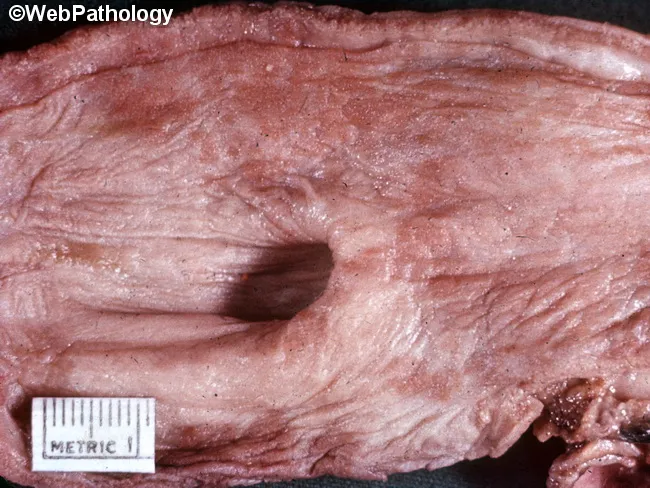 traction diverticulum