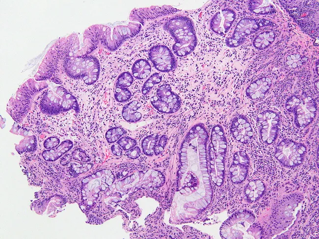 Barrett Esophagus : Microscopic