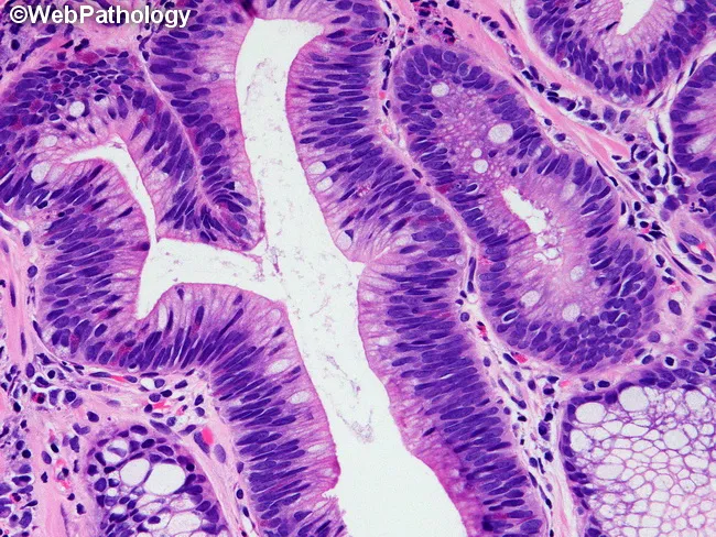 Barrett Esophagus : Low-grade Dysplasia