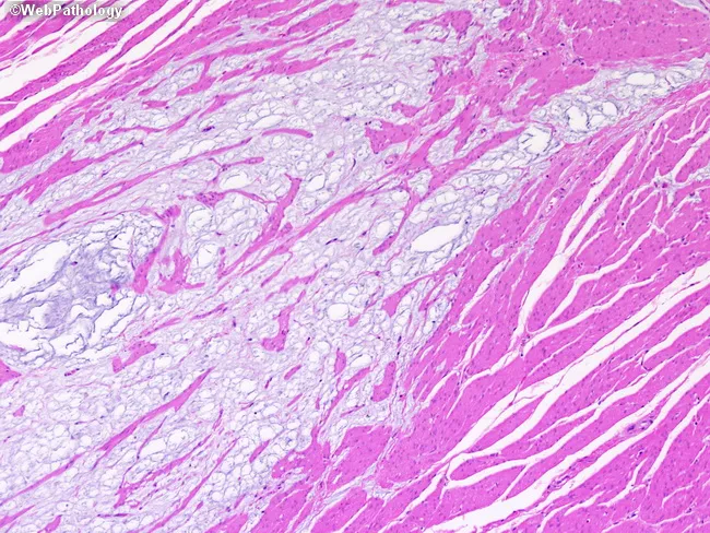 Adenocarcinoma in Barrett Esophagus : Dissecting Mucin