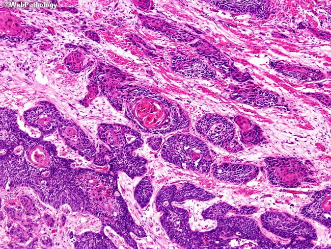 Squamous Cell Carcinoma of Esophagus
