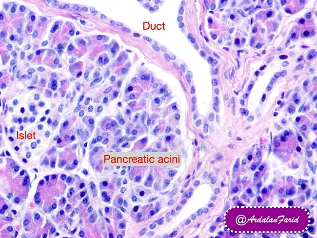Heterotopic Pancreas : Differential