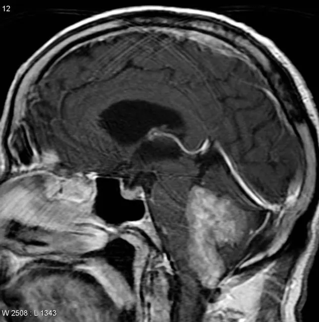 Ependymoma : MRI Scan
