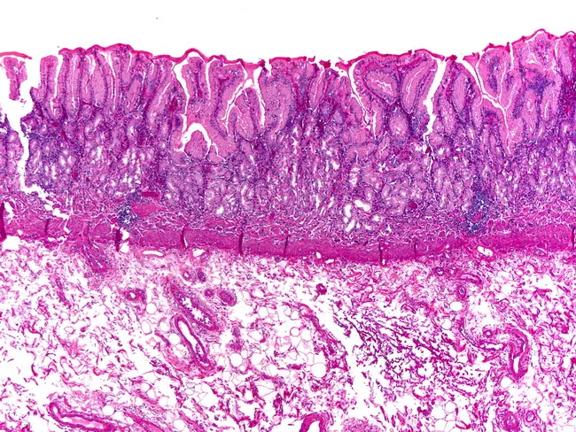 Atrophic Gastritis Nhs