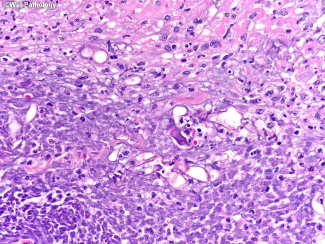 Gastric Mucormycosis : Transplant patient