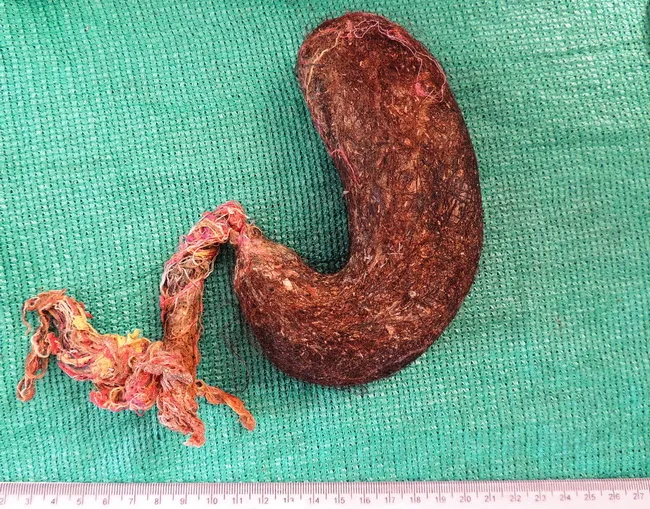 Trichobezoar : Terminology & Clinical Features