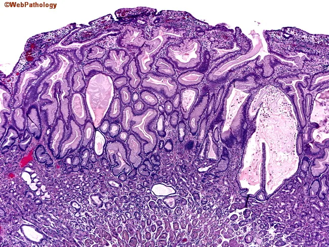 Hyperplastic Polyp