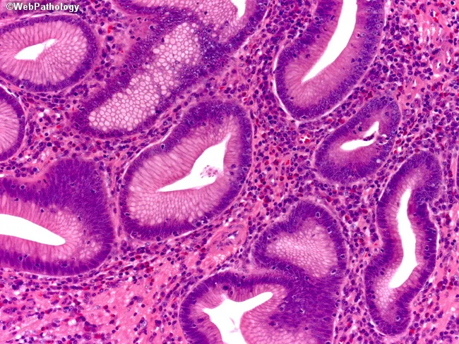Hyperplastic Polyp