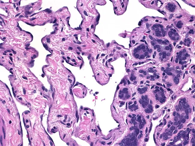 Angiosarcoma of Breast - Low Grade