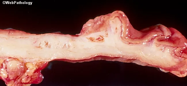 Gastric Adenocarcinoma, Diffuse Type (Linitis Plastica; Signet Ring ...