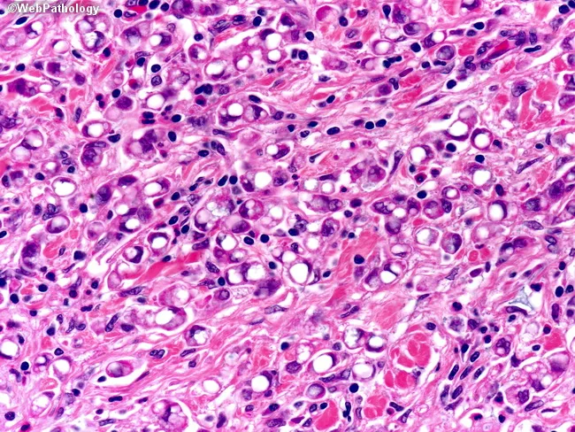 Gastric Adenocarcinoma, Diffuse Type (Linitis Plastica; Signet Ring ...