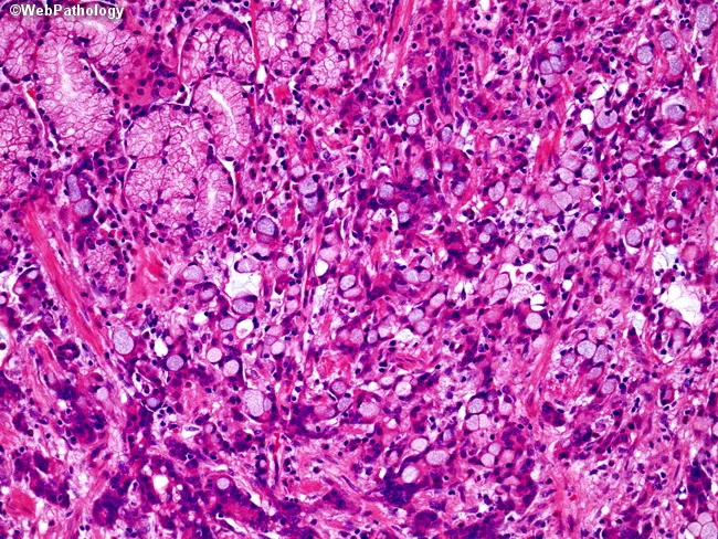 Gastric Adenocarcinoma, Diffuse Type (Linitis Plastica; Signet Ring ...