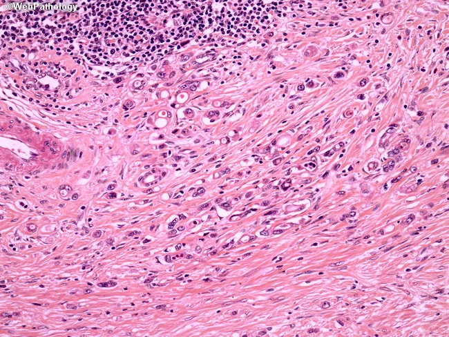 Gastric Adenocarcinoma, Diffuse Type (Linitis Plastica; Signet Ring ...