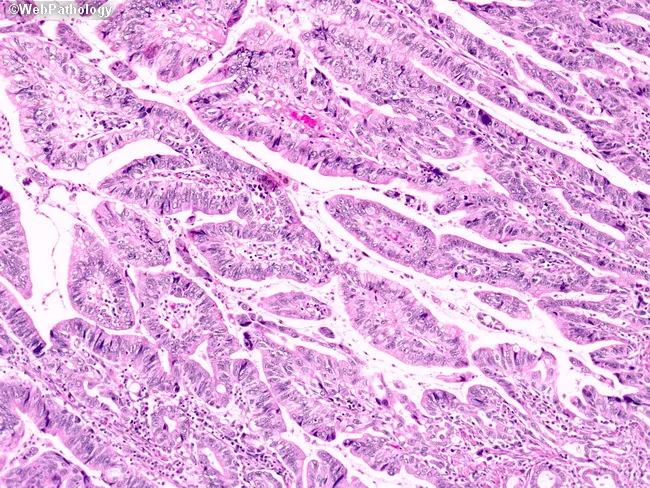 Gastric Adenocarcinoma, Intestinal Type