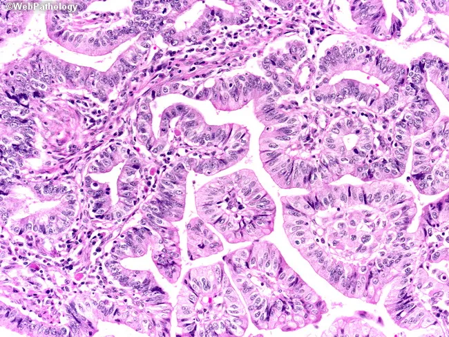 Gastric Adenocarcinoma, Intestinal Type