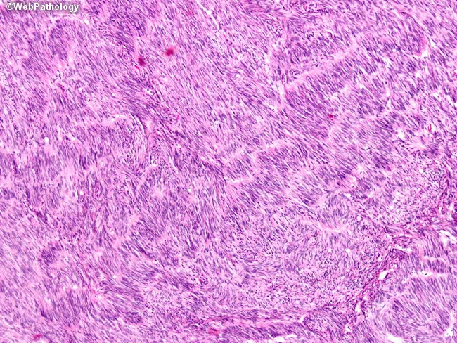 GIST : Palisading pattern