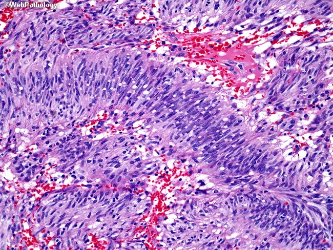 GIST : Palisading pattern