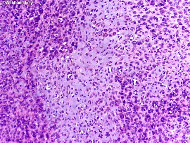 GIST : Epithelioid with Myxoid Matrix