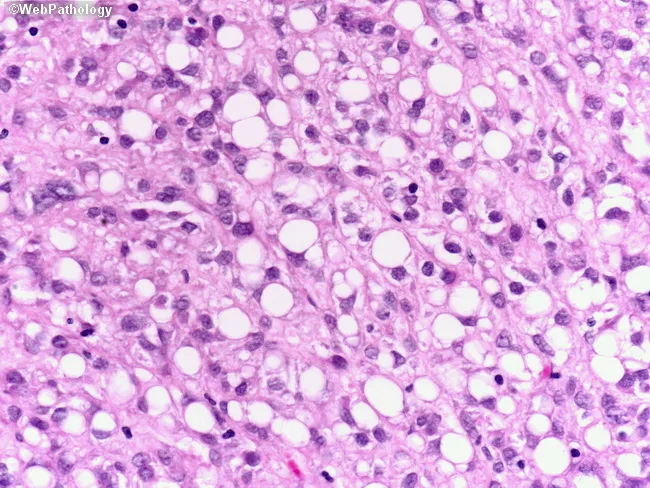 GIST : Epithelioid with Signet Ring Cell Pattern