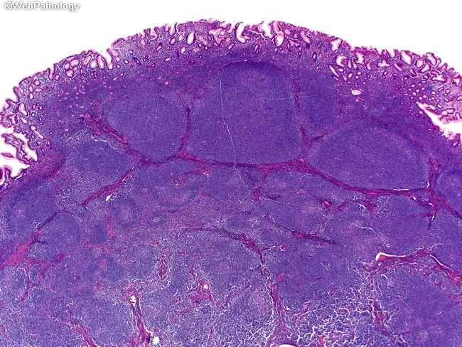 Extranodal Marginal Zone Lymphoma of MALT-type (MALTOMA)