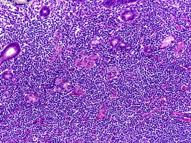 Extranodal Marginal Zone Lymphoma of MALT-type (MALTOMA)