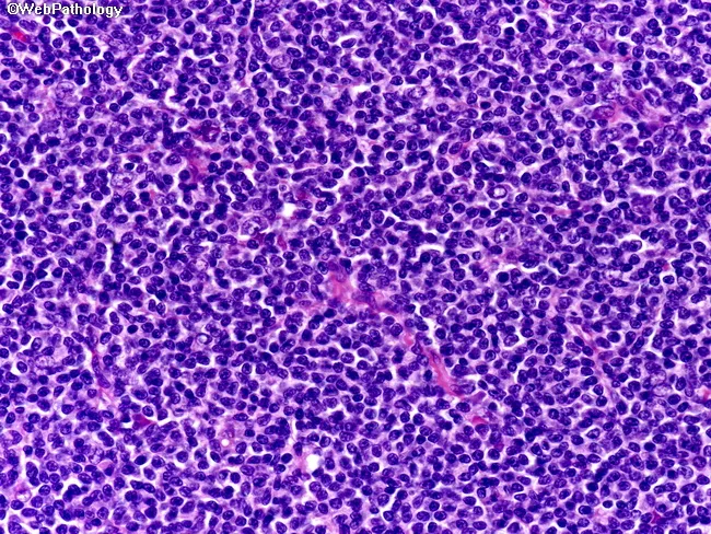 Extranodal Marginal Zone Lymphoma of MALT-type (MALTOMA)
