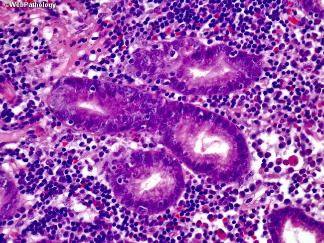 Extranodal Marginal Zone Lymphoma of MALT-type (MALTOMA)