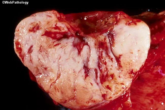 leiomyosarcoma bowel