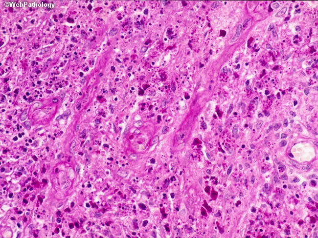 Histoplasmosis : PAS stain
