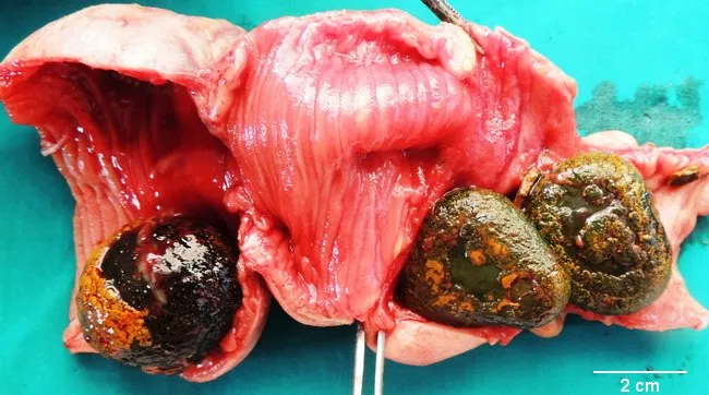 Gallstone Ileus : Clinical Features
