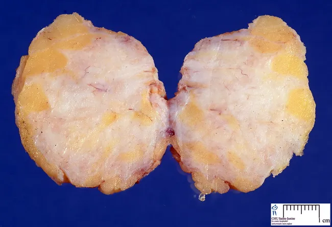 Gynecomastia : Gross Pathology