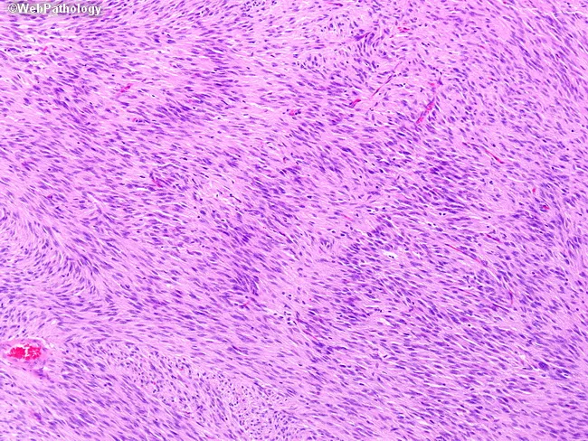GIST of Low Malignant Potential